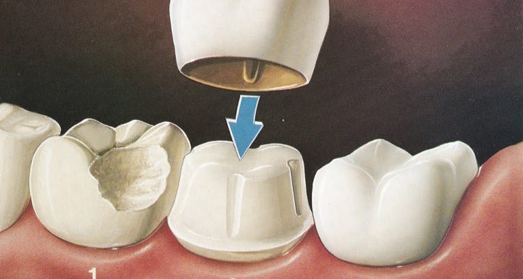 crown procedure albuquerque