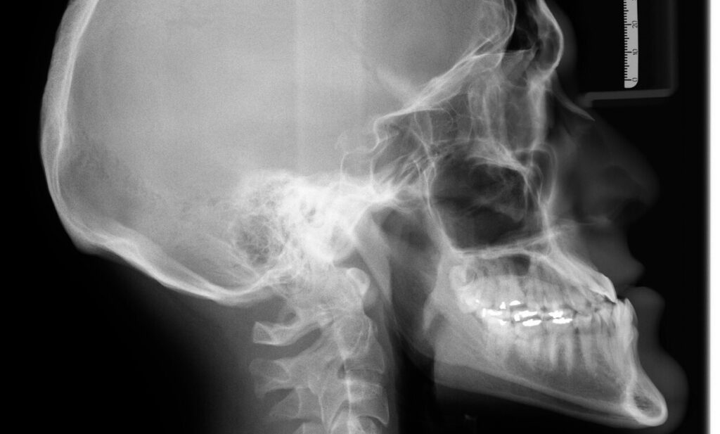 Expert Diet Tips to Follow After the TMJ Surgery | W. Gregory Rose DDS, PA